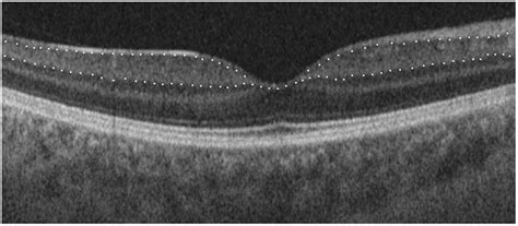 macular ss oct with intraretinal layer segmentation from horizontal