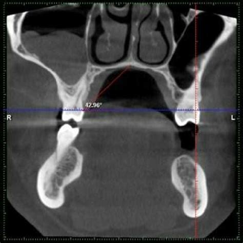 A D Deep Palate With Palatal Vault Angle 40° Download Scientific Diagram