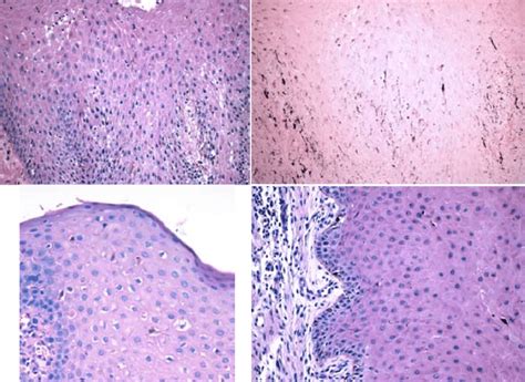 A Case 4 Microscopical Features Of Melanoacanthoma Showing