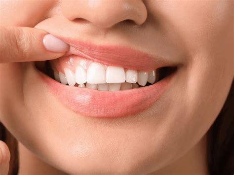 Gengive Bianche Cause Sintomi In Adulti E Neonati