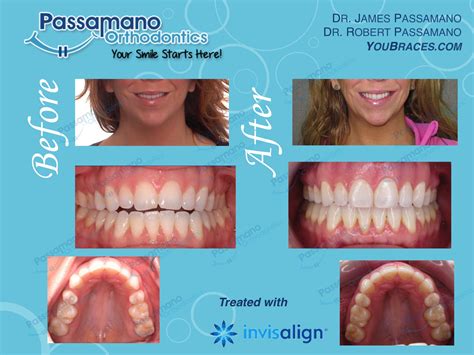 Couldnt Bite Lettuce Open Bite Fixed With Invisalign Orthodontics