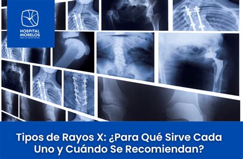 Tipos De Rayos X