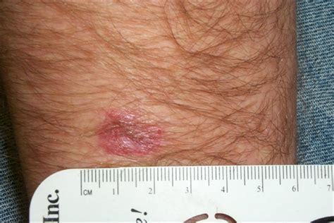 Clinical Challenge Asymptomatic Lesion On The Forearm Mpr
