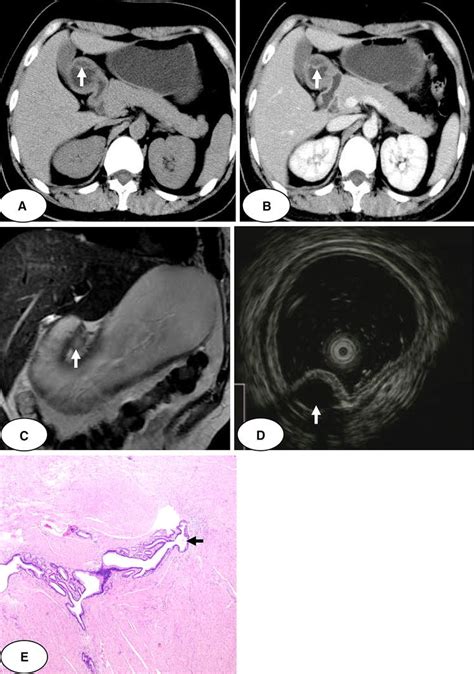 A B Unenhanced Ct And Contrast Enhanced Ct Showed Submucosal Cystic