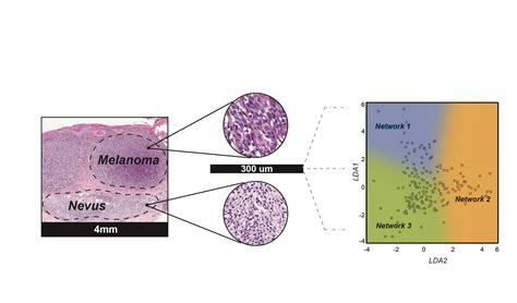 Novel Strategy Using Microrna Biomarkers Can Distinguish Melanomas From