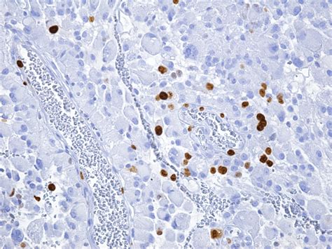 Tumor Cells With Reduced Ki67 Proliferation Index Anti Ki67