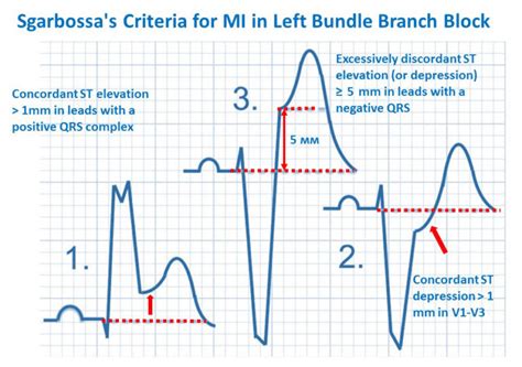 Sgarbossa S Criteria For Mi In Left Bundle Branch Block Clincasequest