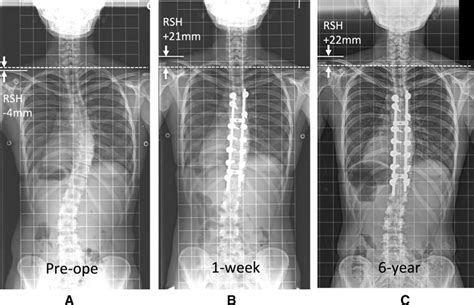 A 19 Year Old Woman Presented With Lenke Type 1a Ais Ps Group A