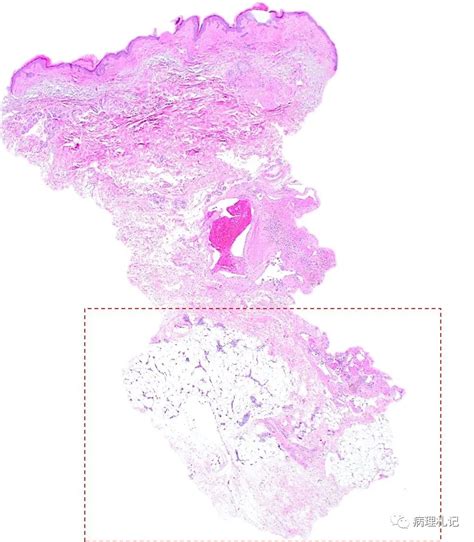 病理视角 经尿道前列腺切除术中前列腺导管腺癌的典型例子 医学界 助力医生临床决策和职业成长