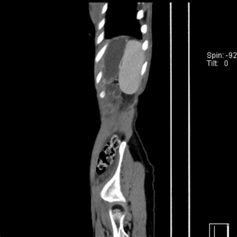 Normal Ct Enterography Radiopaedia 30357 31000 D Nc Commons