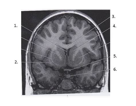 Coronal Cut Brain Quiz