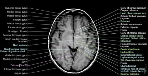 Cross Sectional Anatomy Of The Brain Normal Anatomy E Anatomy
