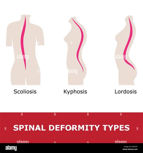 Lordosis Kyphosis Scoliosis