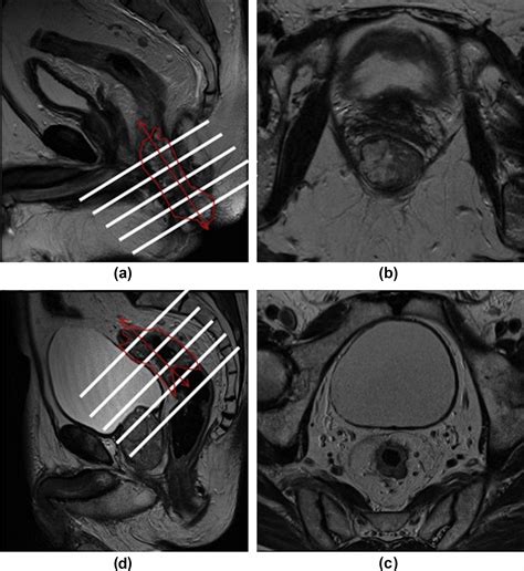 Current Concepts In Imaging For Local Staging Of Advanced Rectal Cancer