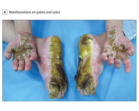 Case Report Describes A 6 Year Old Girl Who Presented With Symmetrical