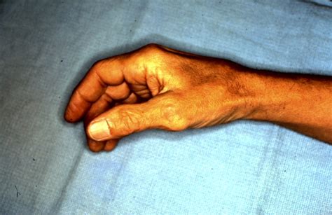 Rcl Reconstruction Thumb Mpj The Hand Treatment Center New Jersey