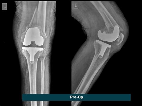 Peri Prosthetic Fractures Surgery And Treatment Ahmedabad