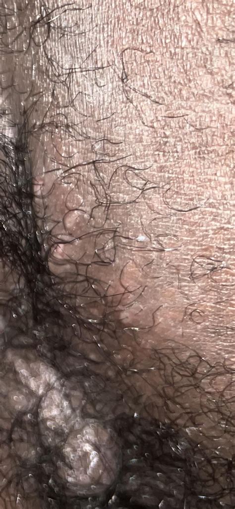 Are These Folliculitis R Folliculitis