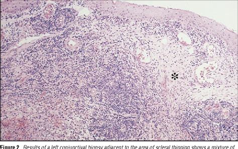 Mycobacterium Chelonae Conjunctivitis And Scleritis Following