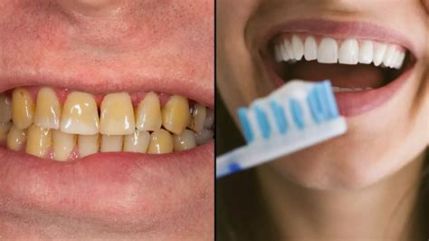 Dentist Shares Three Common Mistakes People Make That Cause Yellow Teeth Health Ladbible