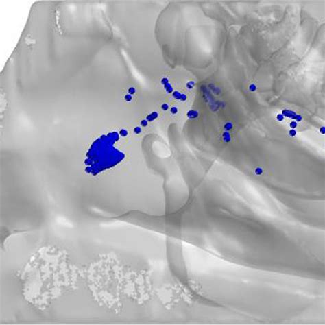 A Coronal View Showing Leftward Septal Deviation B Sagittal View Of