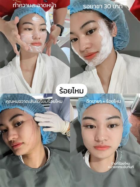 เคล็บลับ หน้า V ยกกระชับทันที ด้วยการร้อยไหม ก่อนวัย 30 แกลเลอรีที่