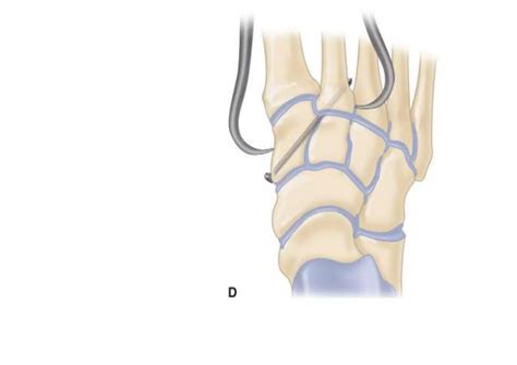 Lisfranc Fracture Dislocation Ppt