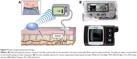 Integrated Insulin Pump Therapy With Continuous Glucose Monitoring For