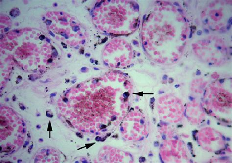 Pyogenic Granuloma Note The Significant Vascular Proliferation And The