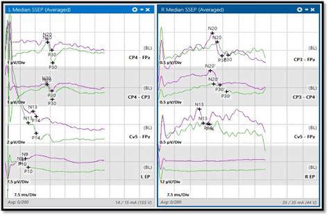 Intraoperative Neurophysiological Monitoring Ionm During Peripheral Nerve Hand Surgeries