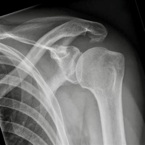 Impingement Syndrom Schulter Gelenkzentrum Zürich Bethanien