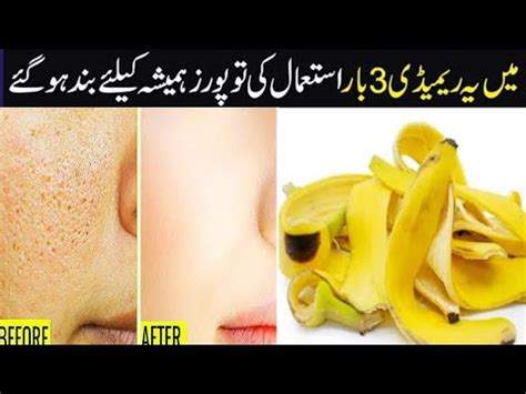 Skin Repair Close Large Open Pores In 1 Week Remove Dark Spots Anti Aging YouTube