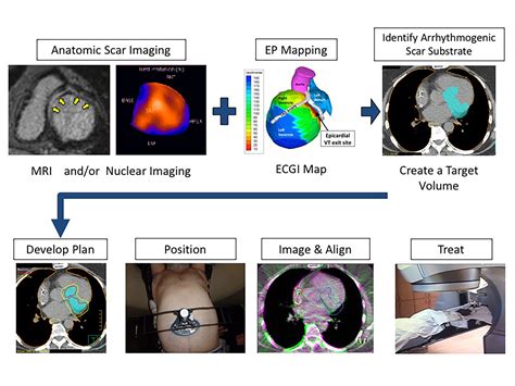 Noninvasive Cardiac Radioablation At Washington University Past Present Future Directions For