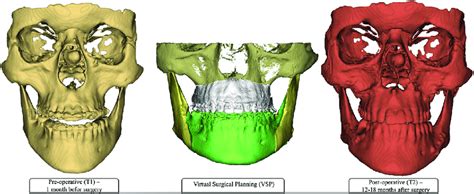 Three Dimensional Reconstruction Of T Cbct Vsp And T Cbct The
