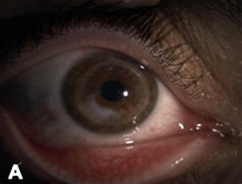 Hypertrophic Corneal Degeneration Most Common In Middle Aged Women