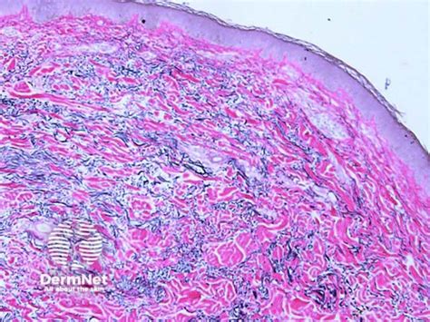 Linear Focal Elastosis