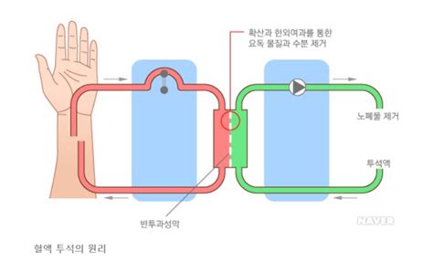 혈액투석 환자돌봄 및 주의사항 소요시간 생활 가이드식이요법 네이버 블로그