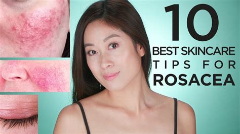 Face Skin Care Routine For Rosacea At Donna Hughes Blog