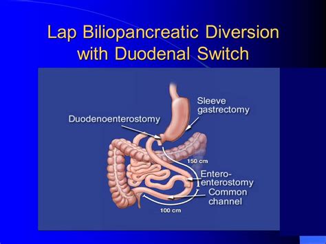 Biliopancreatic Diversion With Duodenal Switch