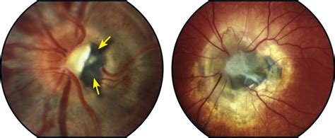 Congenital And Developmental Anomalies Of The Optic Nerve Ento Key