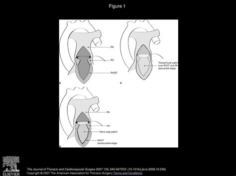 Pulmonary Valve Cusp Augmentation With Autologous Pericardium May Improve Early Outcome For