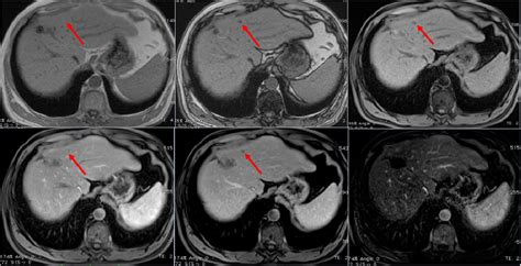 Figure 1 From Mri Ancillary Findings On Hcc Diagnosis Semantic Scholar