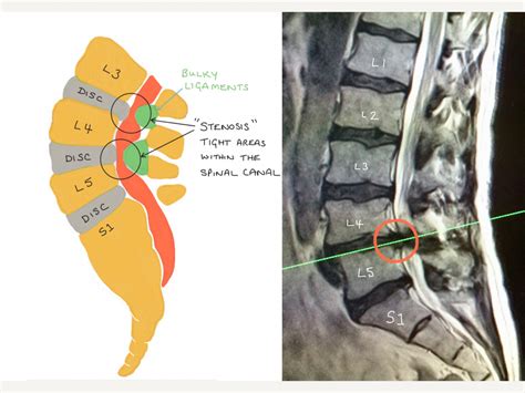 Spinal Stenosis Spines Dorset