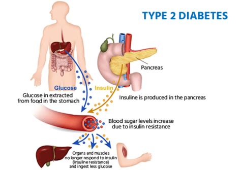 Sulfonylureas And Glinides Role In Type 2 Diabetes Management