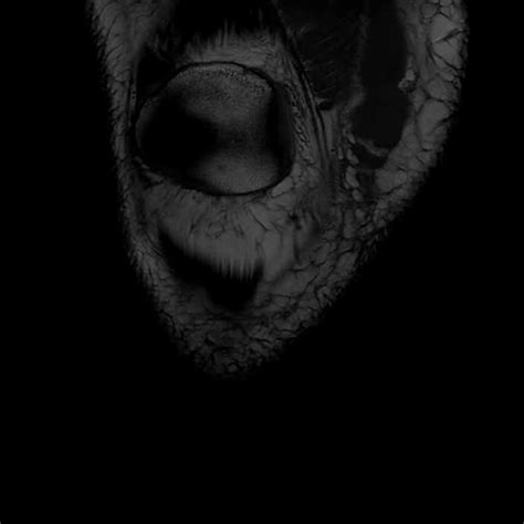 Osteochondritis Dissecans Ocd And Grade I Chondromalacia Patella