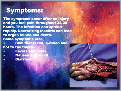 Necrotizing Fasciitis 1