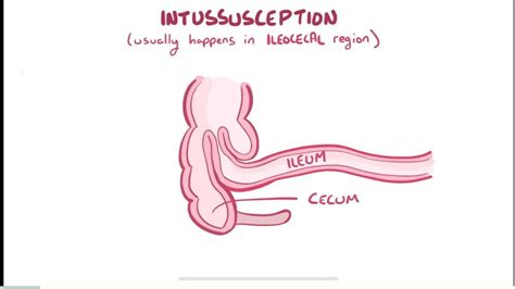 Partial Intestinal Obstruction Secondary To Intussusceptionpptx