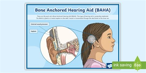 Bone Anchored Hearing Aid Baha Display Poster Twinkl