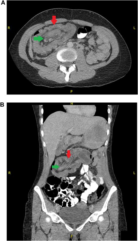 Mucinous Appendix Intussusception Case Report Pmc