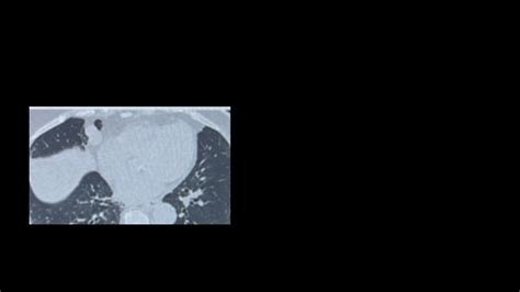 Giuseppe La Mattina On Linkedin 20 Mm Hypermetabolic Nodule Suvmax 3